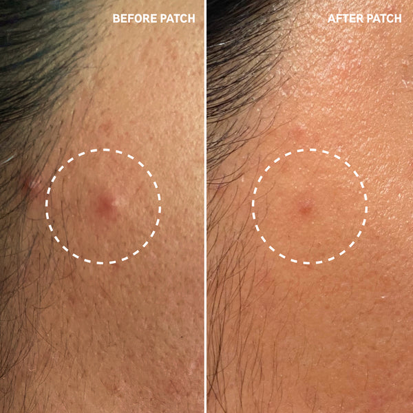 Hydrocolloid Spot And Pimple Patch The Inkey List Uk